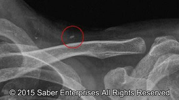 Alien Implant Photo | Coast to Coast AM