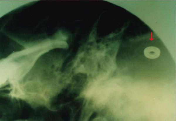 Alien Implants: Photo & Video | Coast to Coast AM