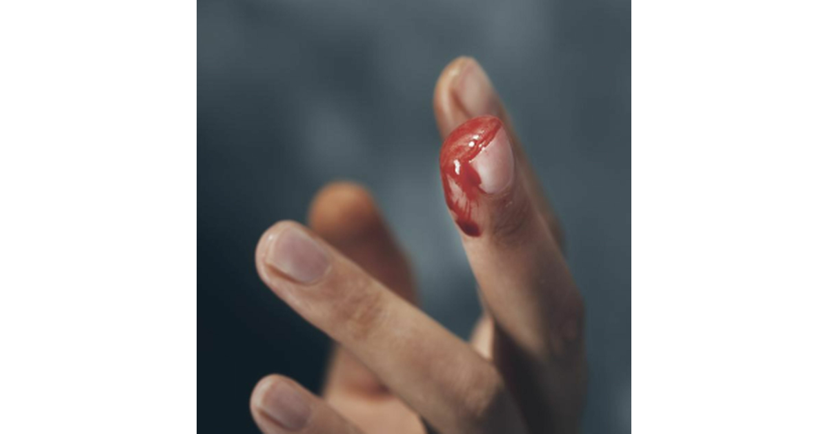 How to Treat a Skin Avulsion Finger Wound: Step-By-Step Guide With ...