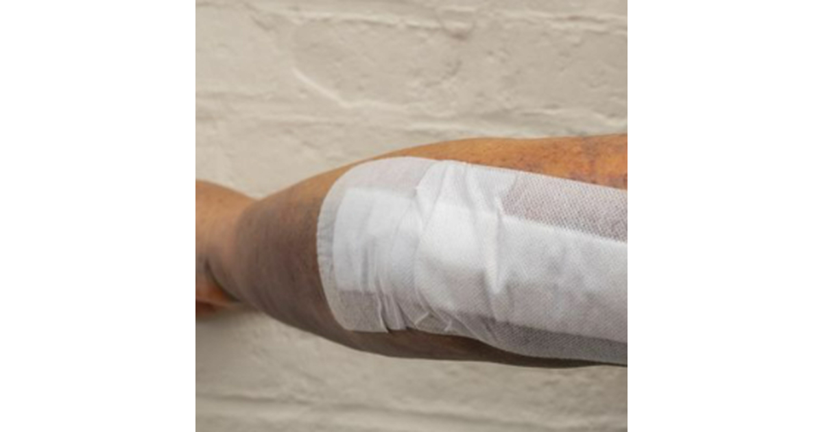 Kerecis Omega 3 Skin Substitute: Advanced Graft Application for Better ...